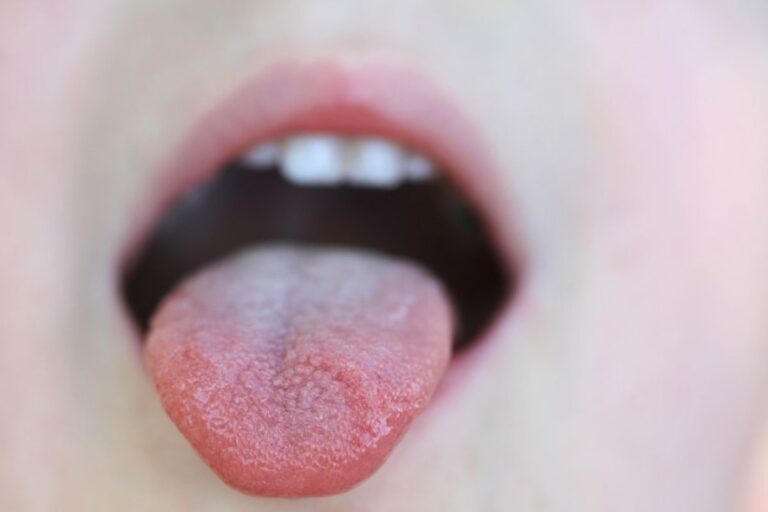 Tumore alla lingua, ecco come scoprirlo in tempo: non sottovalutare ...